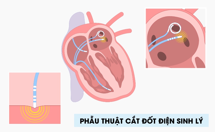 Nhịp tim 100 có nguy hiểm không? Biến chứng và cách cải thiện