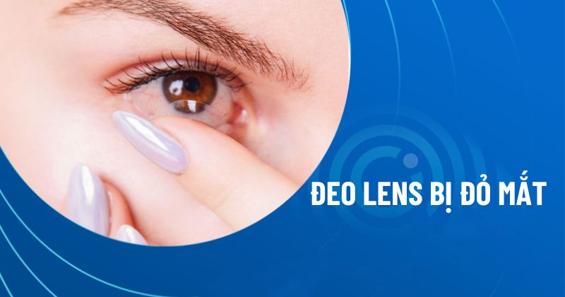 Tật khúc xạ là gì? Nguyên nhân, triệu chứng và cách phòng ngừa