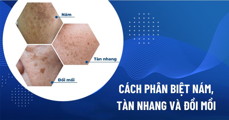 Cách phân biệt nám tàn nhang đồi mồi chi tiết có kèm hình ảnh