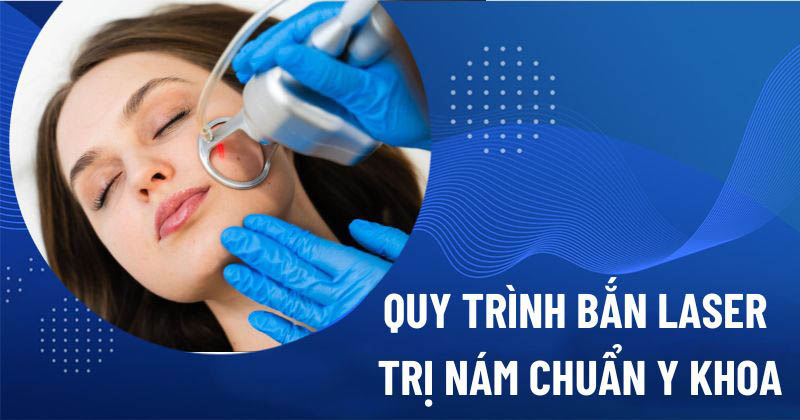 Quy trình bắn laser trị nám chuẩn y khoa hiệu quả vượt trội