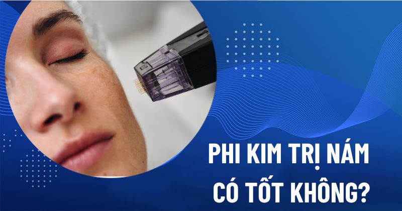 Phi kim trị nám có tốt không? Có nên cân nhắc điều trị không?
