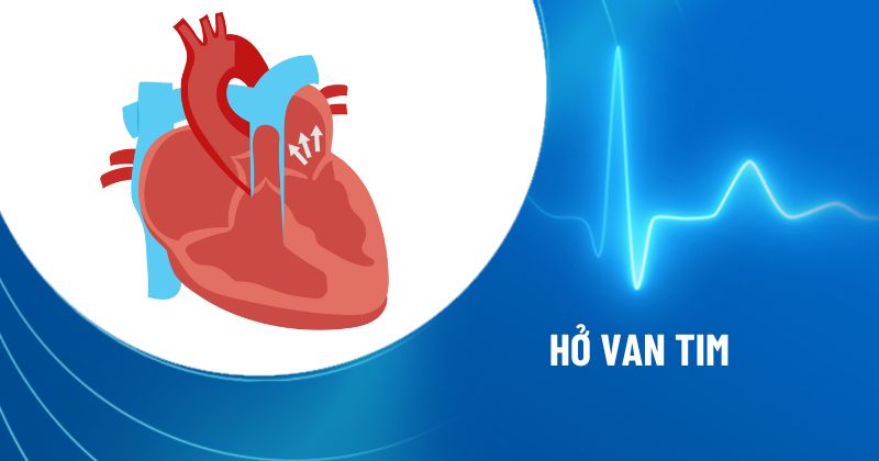 Hở van tim: Nguyên nhân, phân loại mức độ và triệu chứng